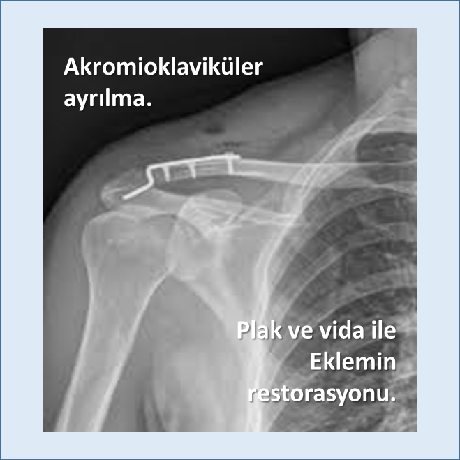 Akromioklaviküler Eklem Çıkığı